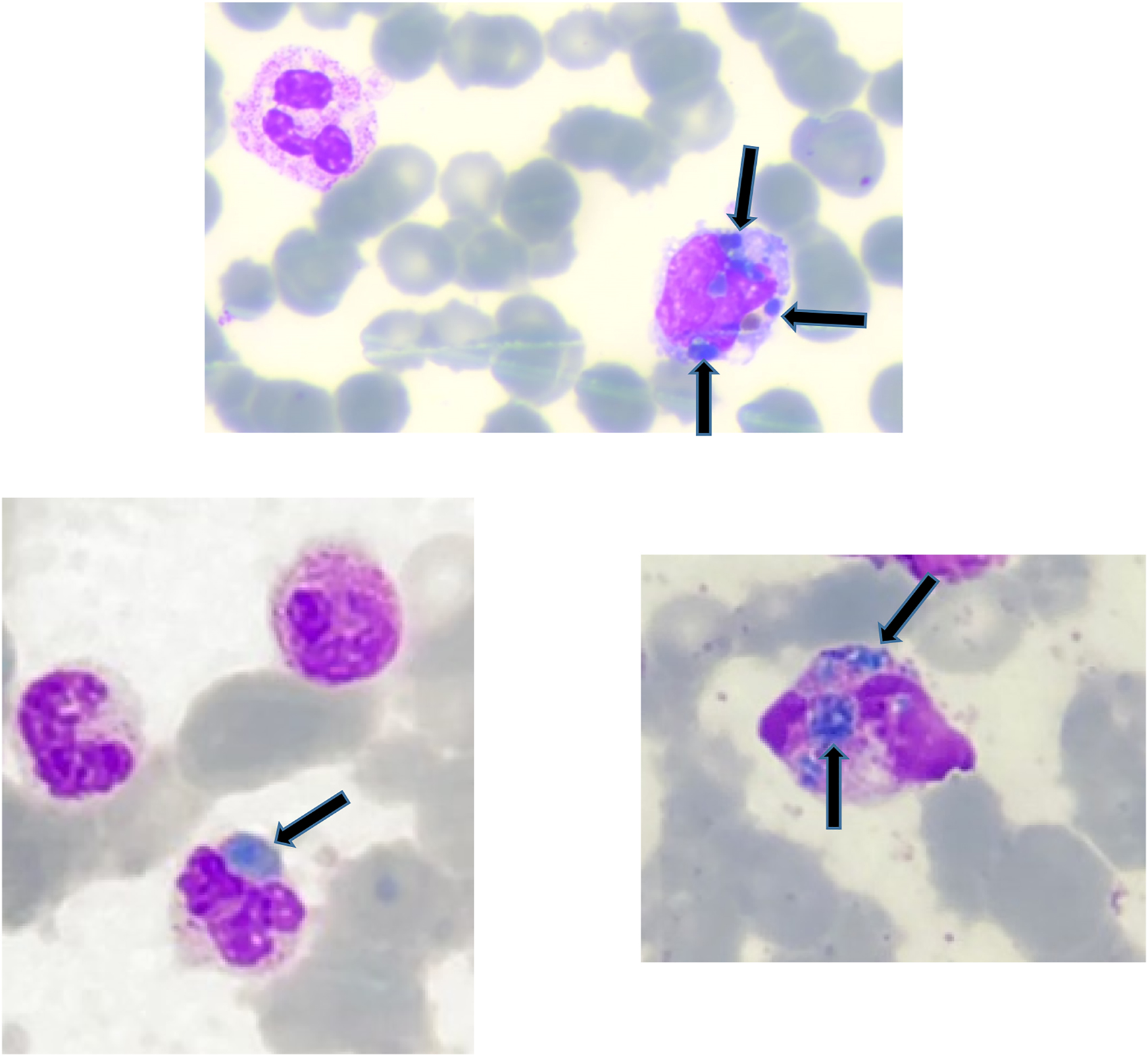 Inclusiones azul-verdosas en los neutrófilos acompañadas de fallo ...