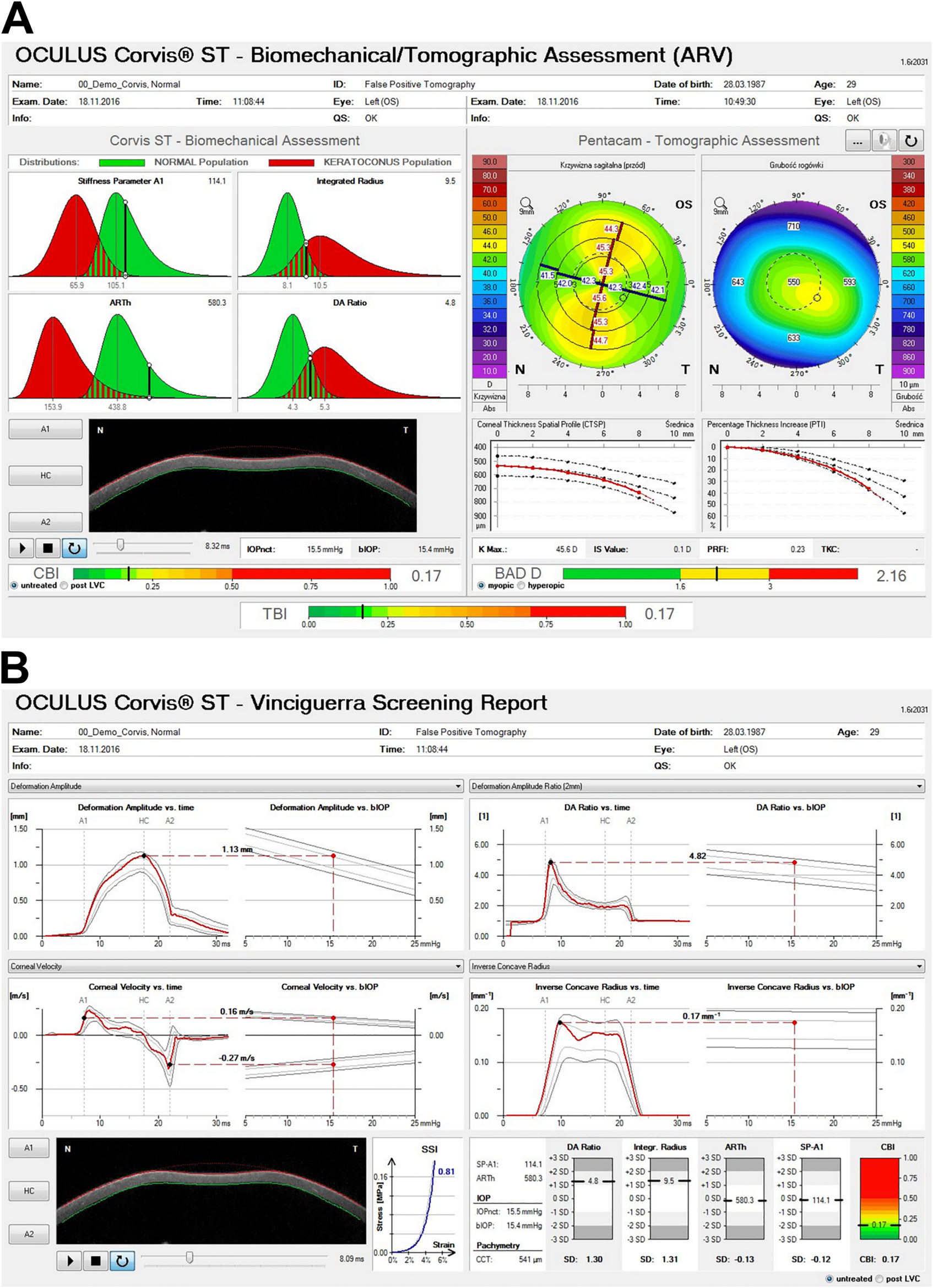 Probing biomechanical properties of the cornea with air-puff-based ...