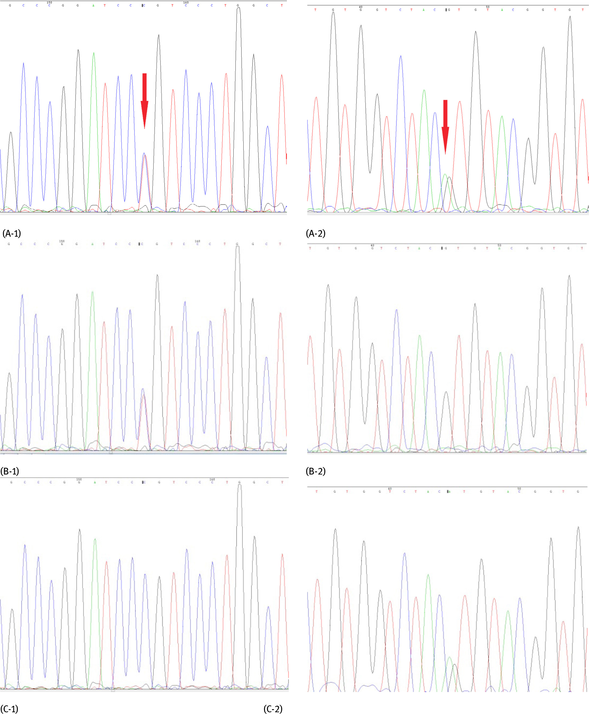 Study of Seizure-Manifested Hartnup Disorder Case Induced by Novel ...
