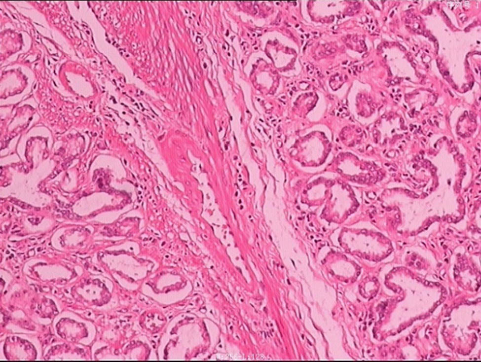 Large Brunner’s gland adenoma of the duodenum for almost 10 years