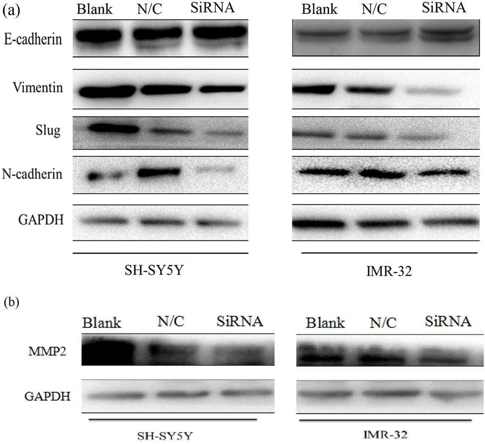 Active legumain promotes invasion and migration of neuroblastoma by ...