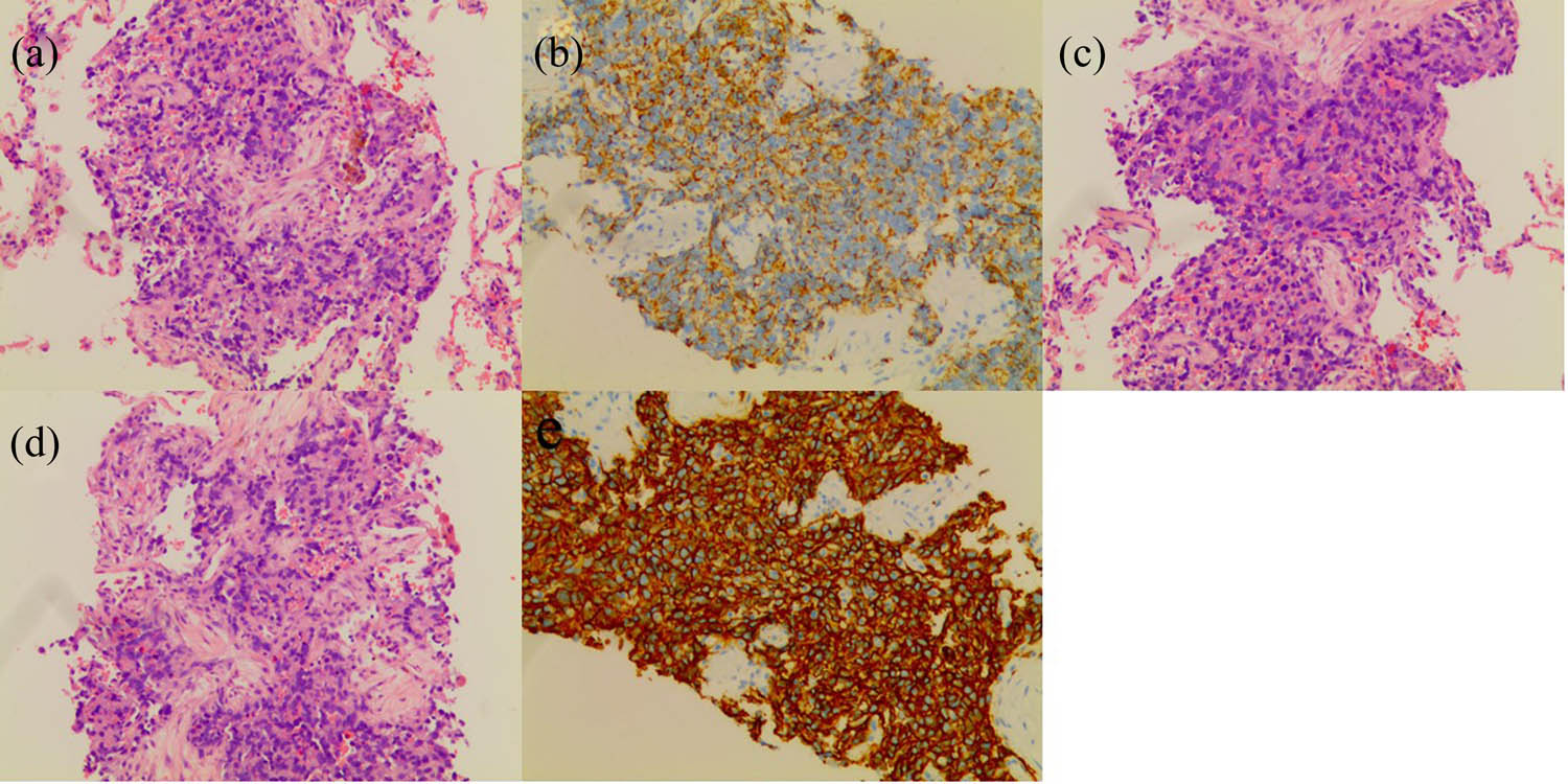 Rapid death due to pulmonary epithelioid haemangioendothelioma in ...