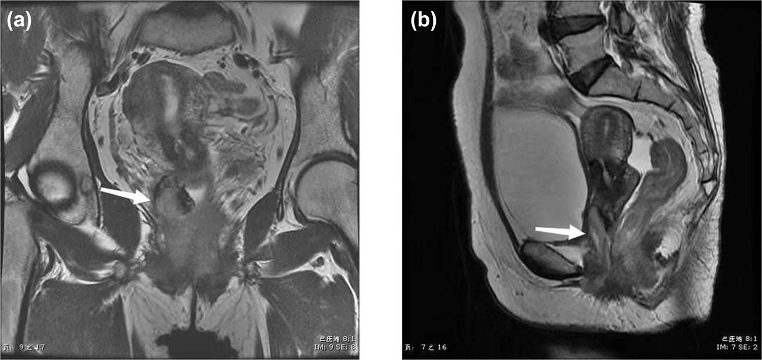 Vaginal metastasis from breast cancer: A case report