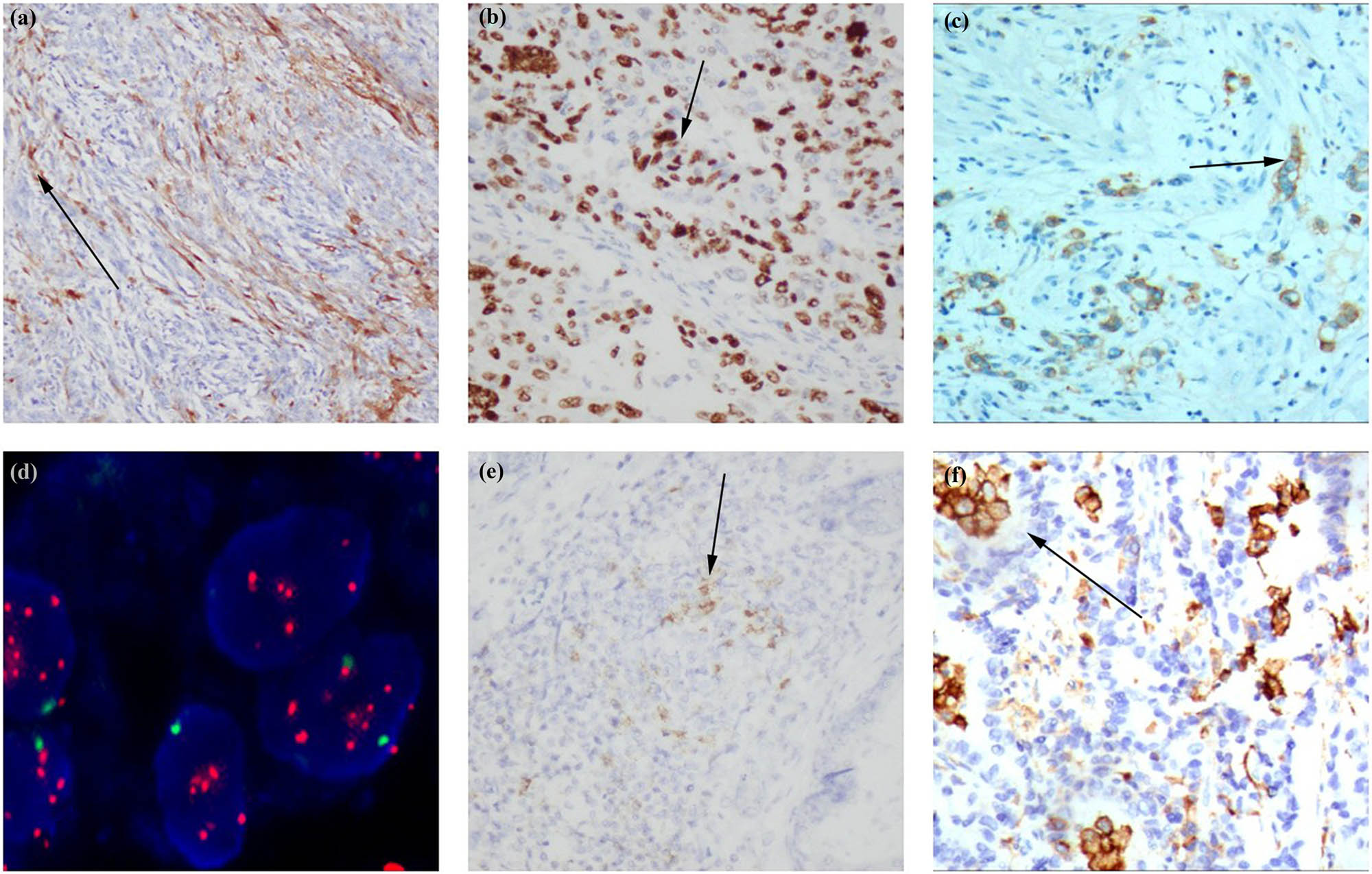 Clinicopathological features and differential diagnosis of gastric ...