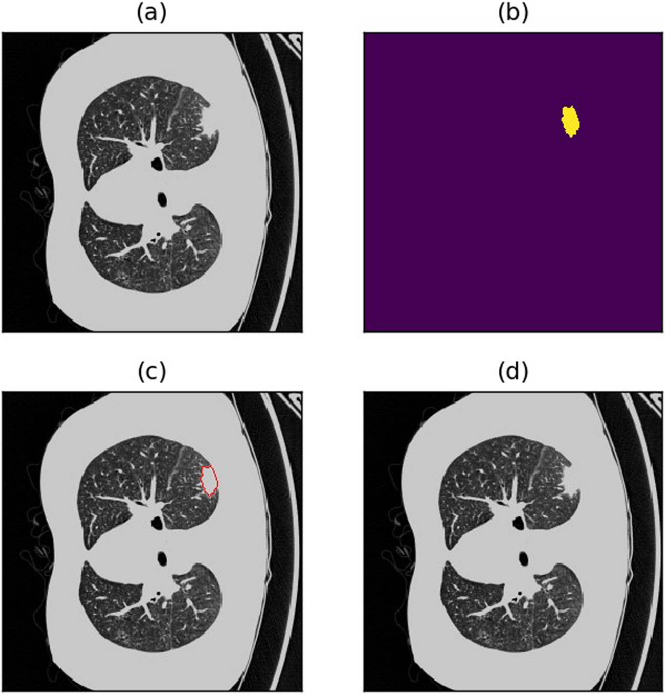 Lung nodule segmentation via semi-residual multi-resoluti...