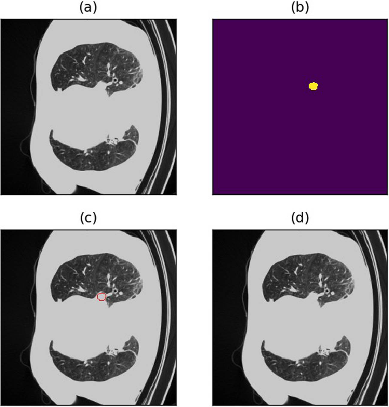 Lung nodule segmentation via semi-residual multi-resoluti...