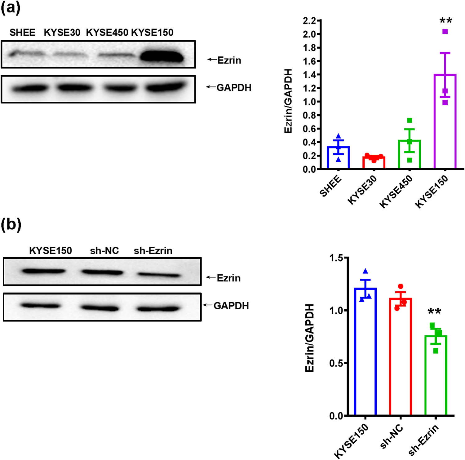 Ezrin promotes esophageal squamous cell carcinoma progression via the ...