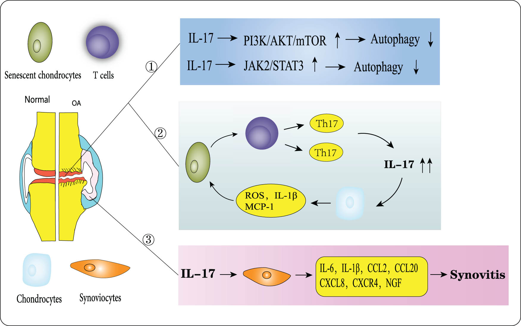 IL-17 in osteoarthritis: A narrative review