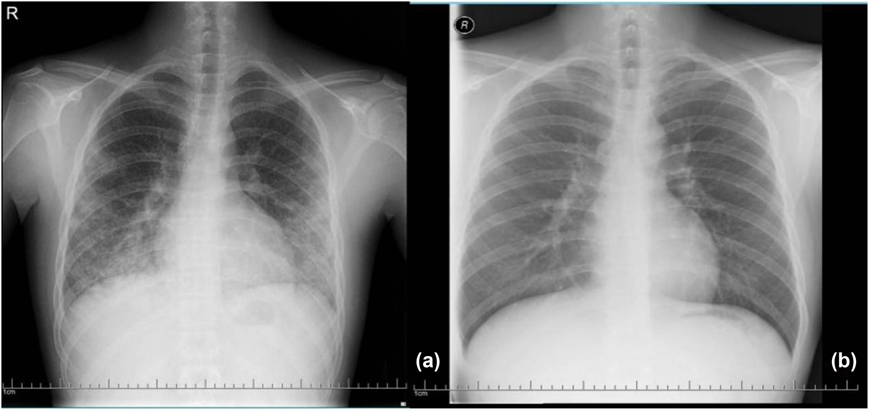 Acute lupus pneumonitis resembling miliary tuberculosis: