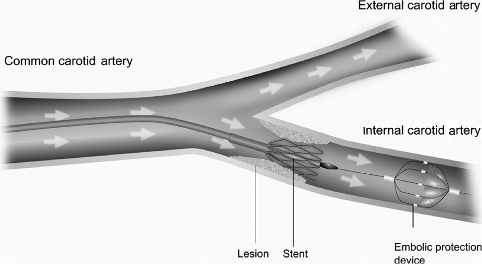 Efficiency test of current carotid embolic protection devices