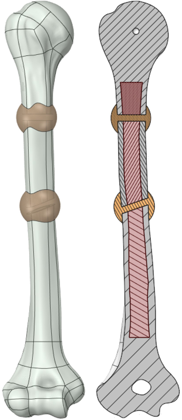 Does helical plating for proximal humeral shaft fractures benefit bone ...