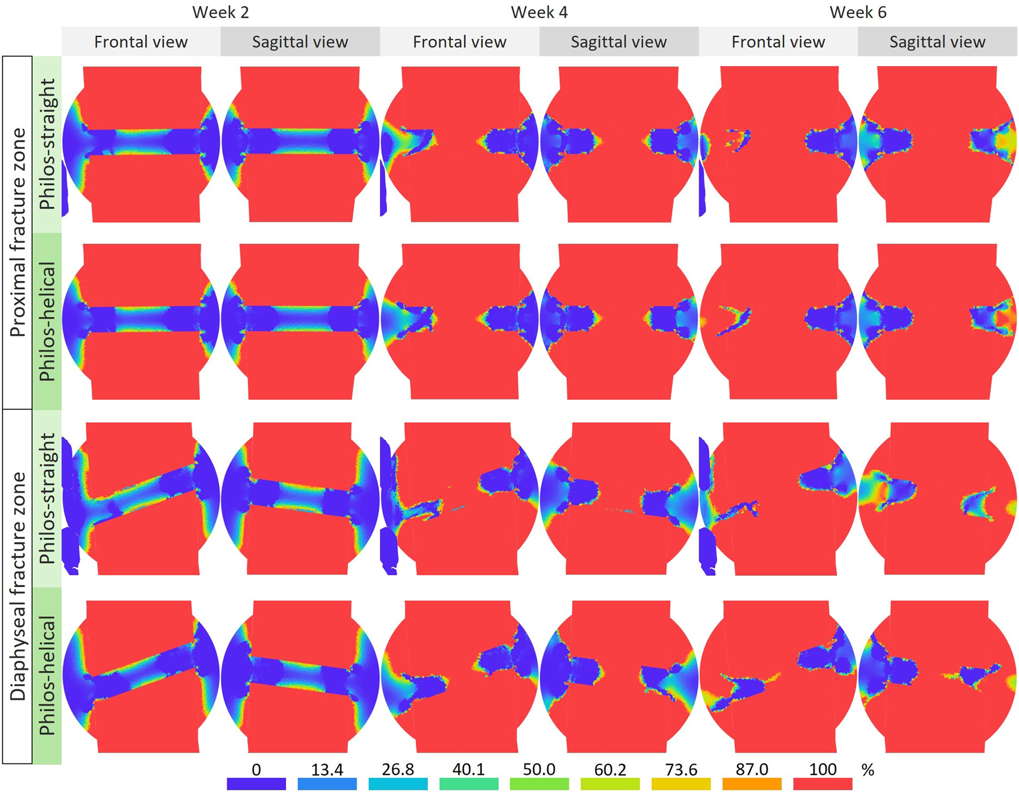 Does helical plating for proximal humeral shaft fractures benefit bone ...