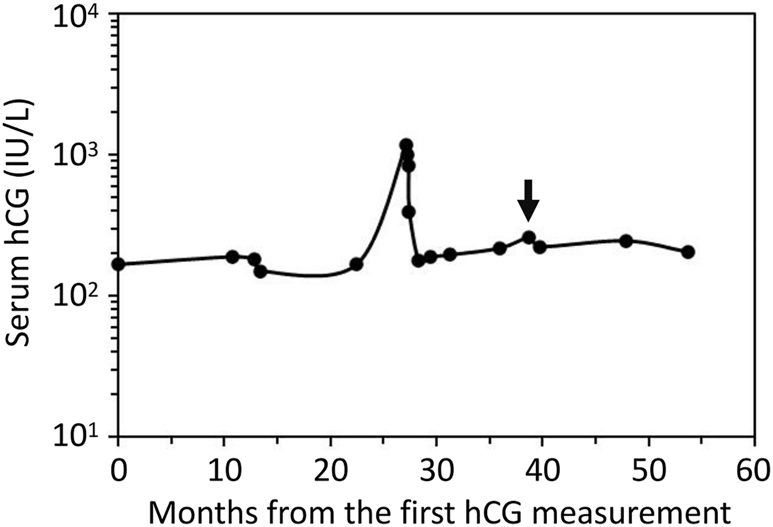 Persistently elevated serum concentrations of human chorionic ...