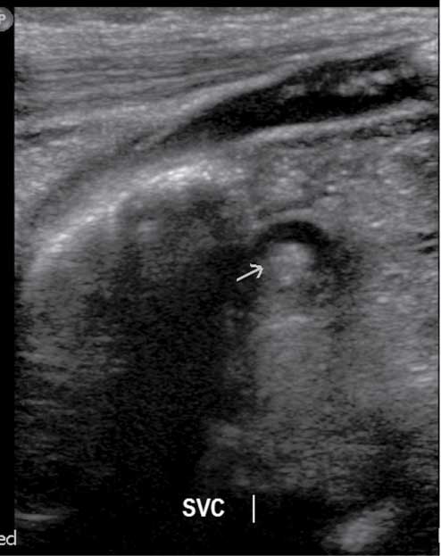 Superior vena cava syndrome causing chylothoraces in a preterm neonate ...