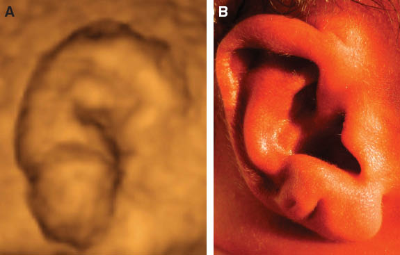 Three-dimensional ultrasound of massive macroglossia in a fetus with ...