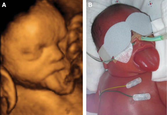 Three-dimensional ultrasound of massive macroglossia in a fetus with ...