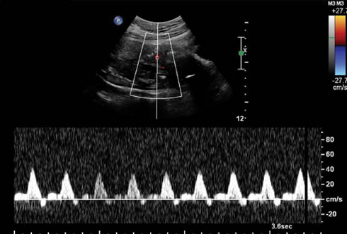 Triphasic umbilical artery waveform: association with severe fetal ...