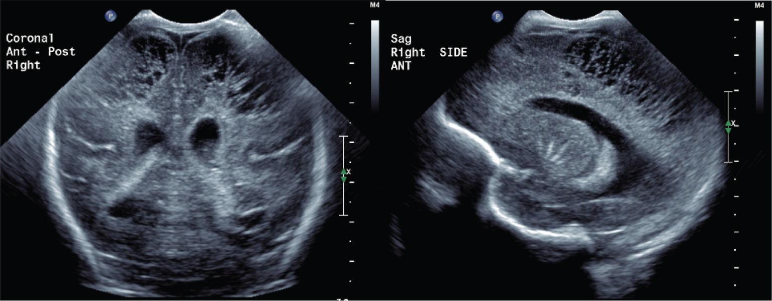 A premature baby with bilateral pleural effusions, Turner syndrome ...