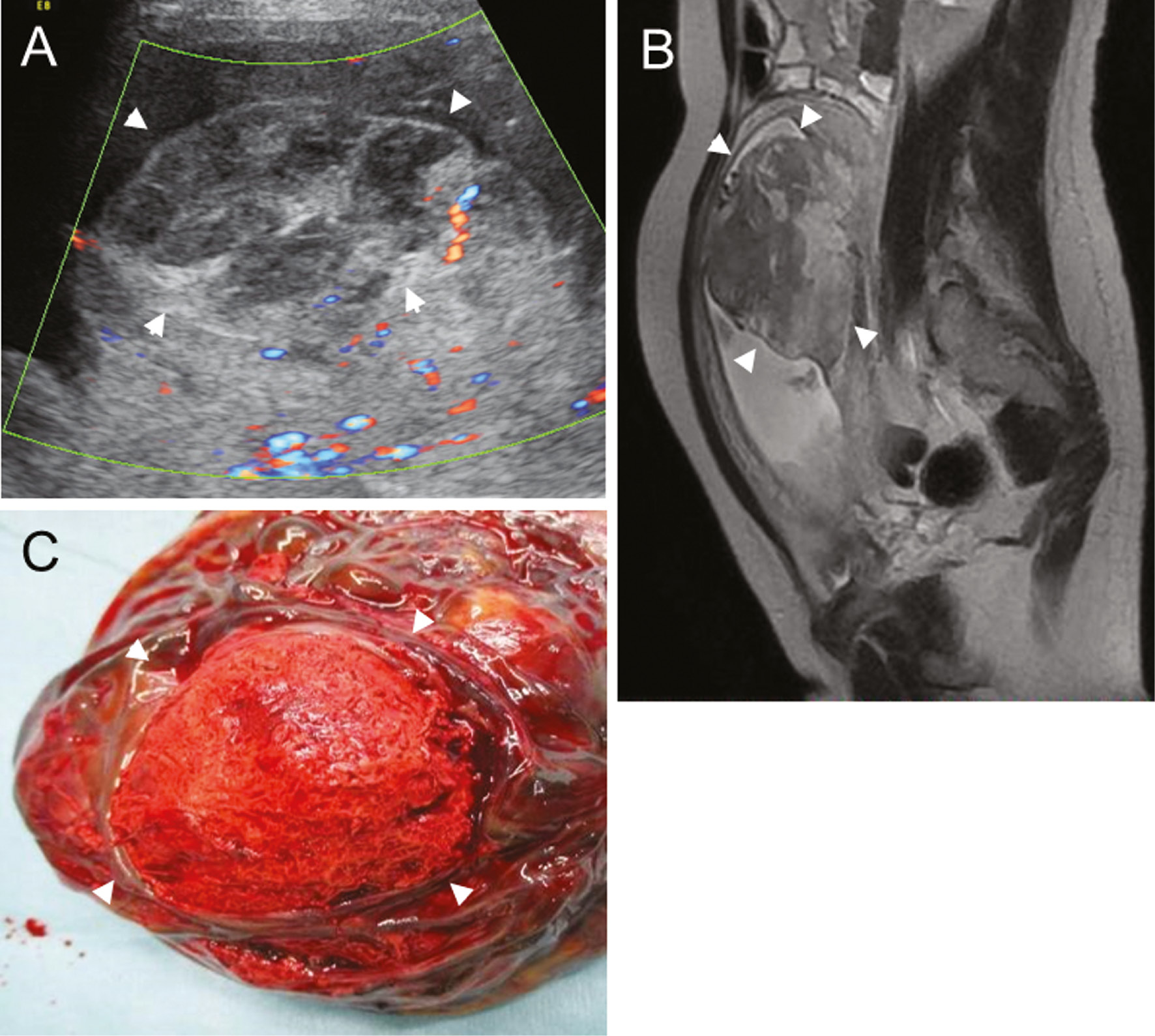 Two cases of massive subchorionic thrombosis