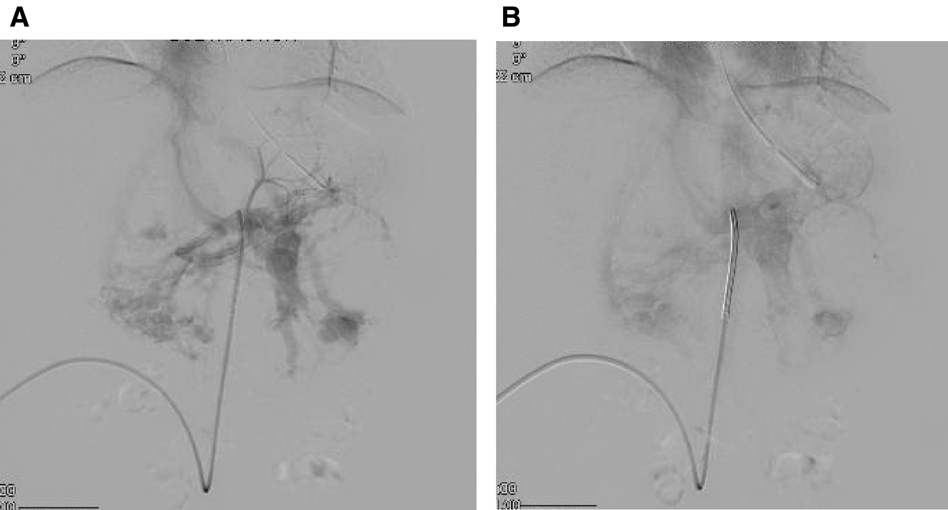 A rare case of a neonatal hepatic tumor presenting as hydrops fetalis