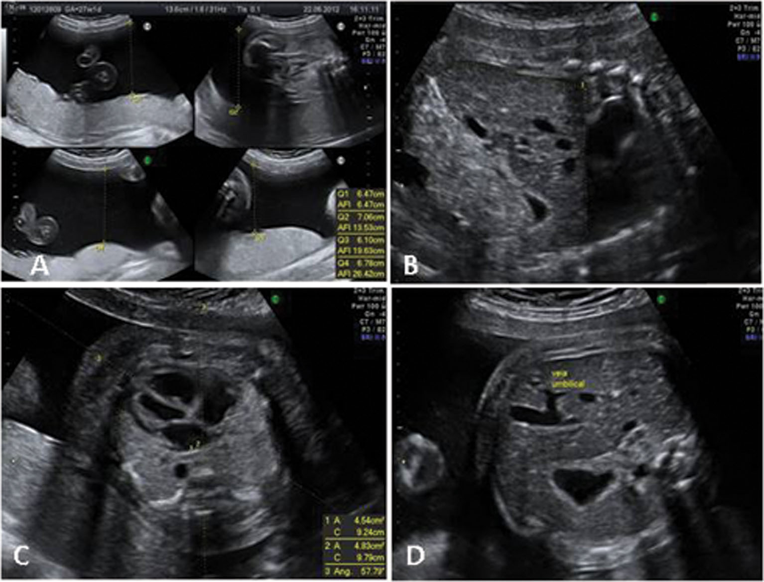 Non-immune fetal hydrops of metabolic origin: a case report and a ...