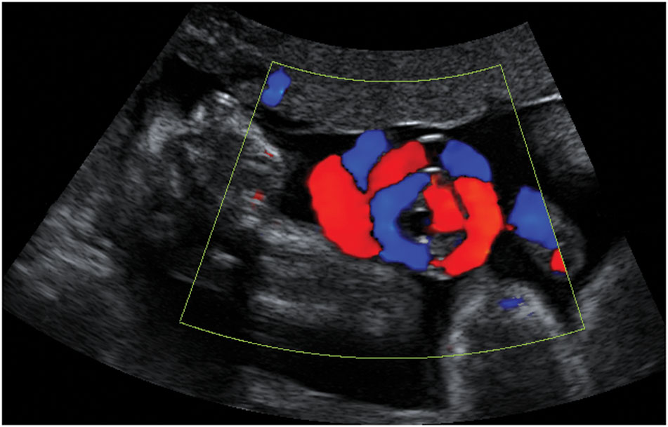 Prenatal detection and obstetric management of true umbilical cord ...
