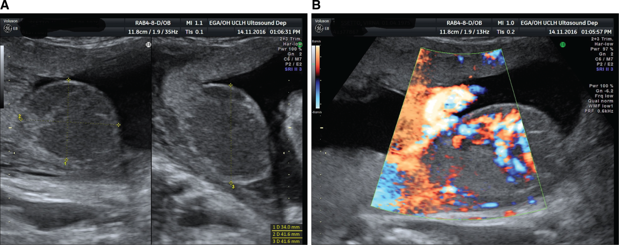 Large placental chorioangioma: a potential effective in-utero treatment ...