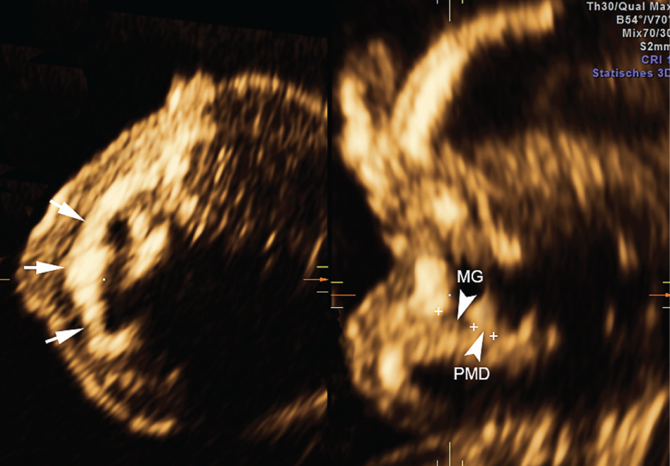 Typical changes of ethmocephaly and holoprosencephaly in a fetus at 14 ...