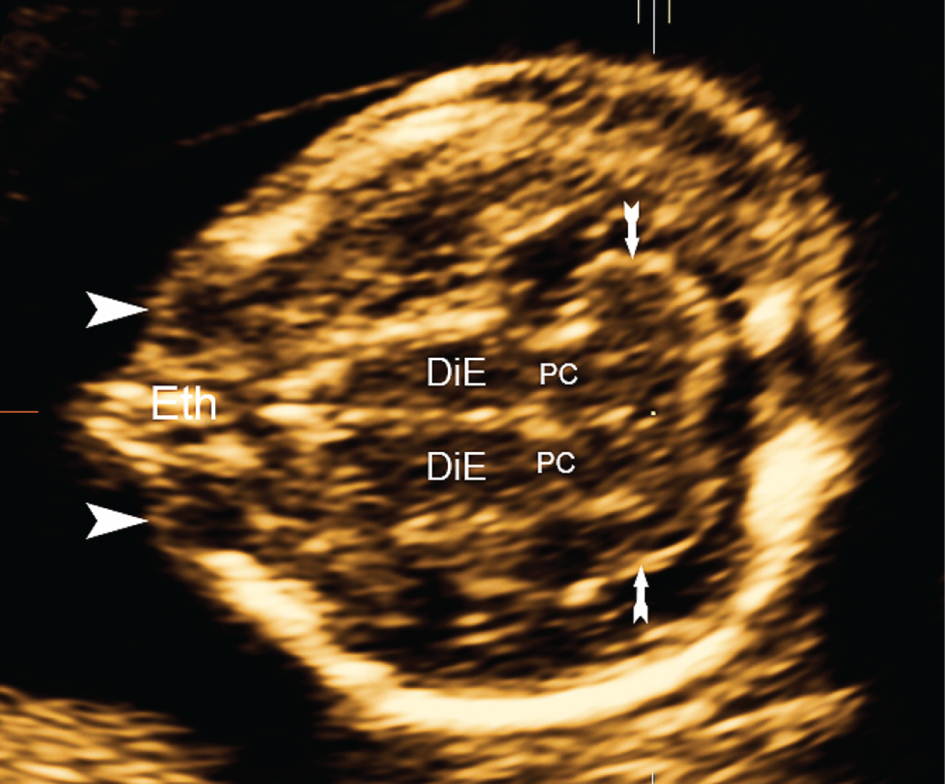 Typical changes of ethmocephaly and holoprosencephaly in a fetus at 14 ...