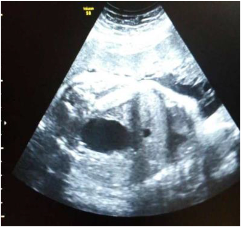 Posterior urethral valves (PUVs): prenatal ultrasound diagnosis and ...