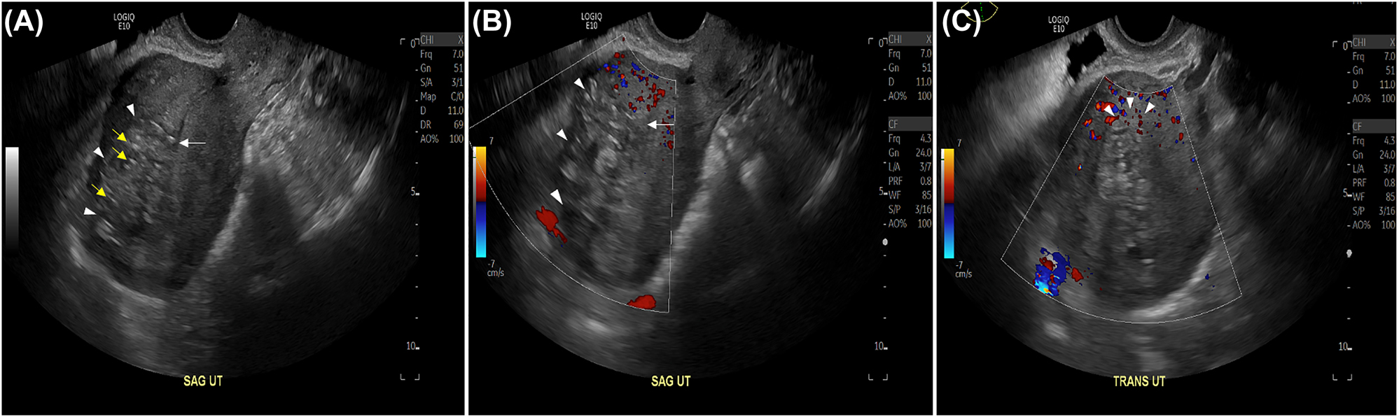 Multimodal postpartum imaging of a severe case of Couvelaire uterus