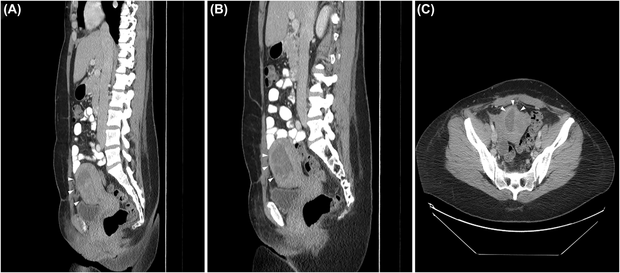 Multimodal postpartum imaging of a severe case of Couvelaire uterus