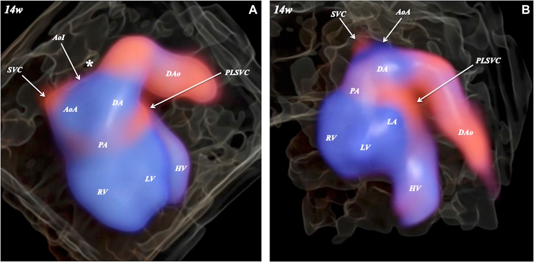 Coarctation of the aorta and persistent left superior vena cava: HDlive ...