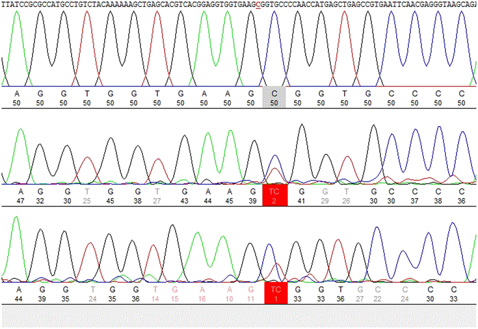 Prenatal diagnosis of ectrodactyly-ectodermal dysplasia clefting ...