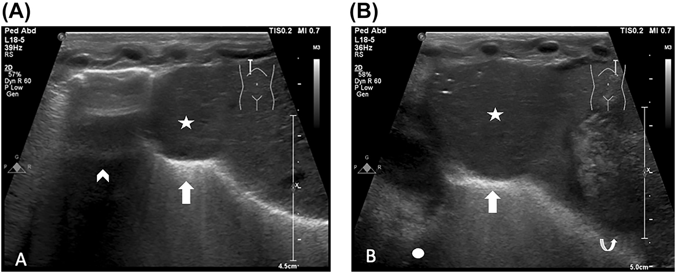 Physiological pulmonary assessments in the management of bilateral ...