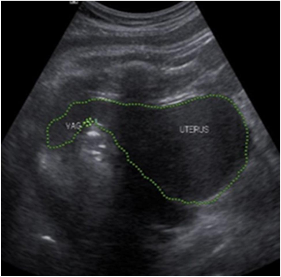 Antenatal ultrasound diagnosis of huge fetal hydrometrocolpos secondary ...