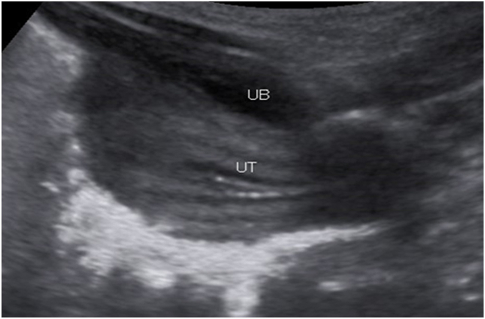 Antenatal ultrasound diagnosis of huge fetal hydrometrocolpos secondary ...