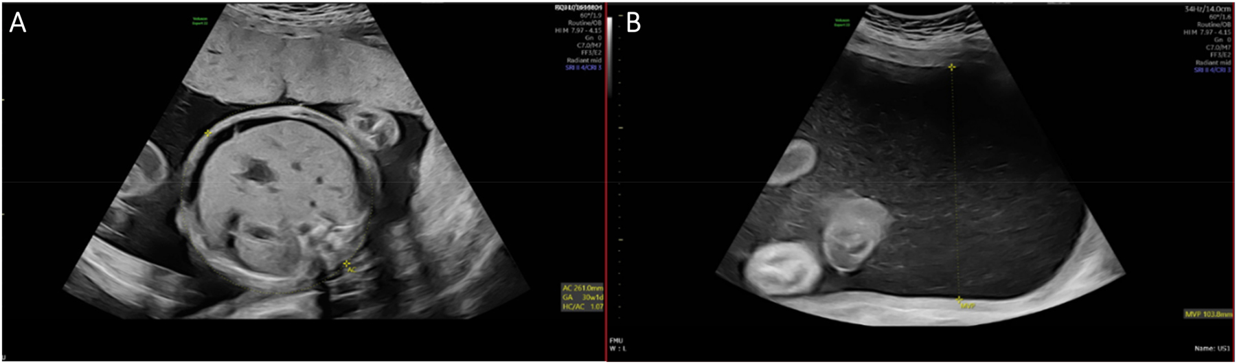 Radiofrequency thermal ablation of giant placental chorioangioma ...