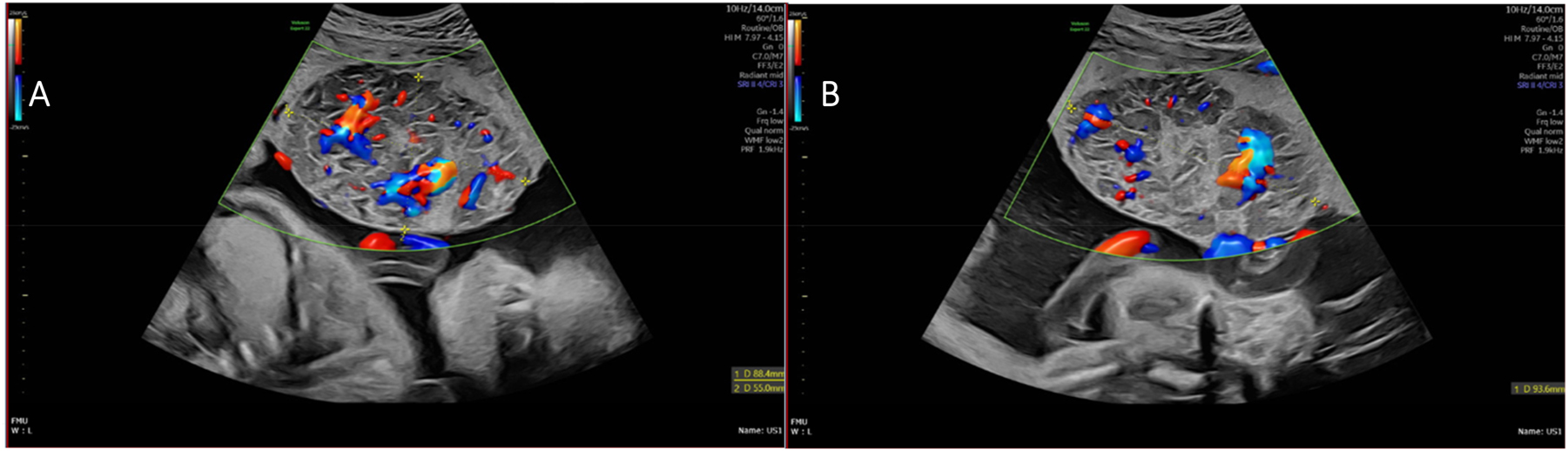 Radiofrequency thermal ablation of giant placental chorioangioma ...