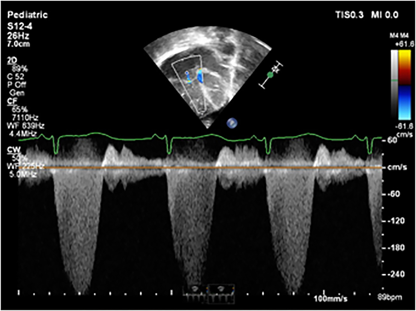 Persistent pulmonary hypertension of the newborn infant (PPHN) due to ...