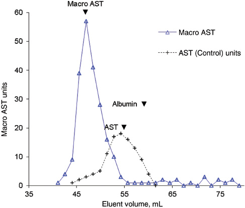 Persistently raised aspartate aminotransferase (AST) due to macro-AST ...