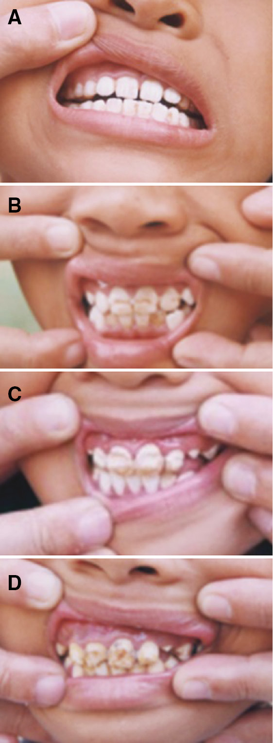 Treatment of fluoride in well-water in Khanhhoa, Vietnam by aluminum ...