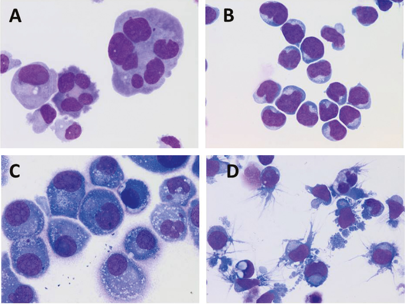 Hodgkin lymphoma cell lines: to separate the wheat from the chaff