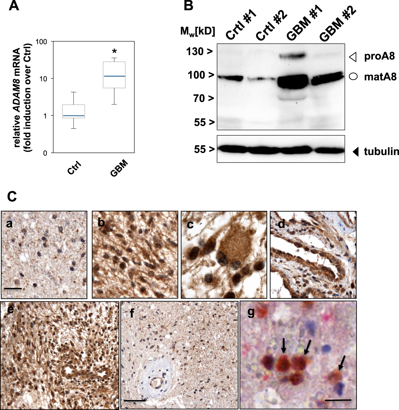 ADAM8 affects glioblastoma progression by regulating osteopontin ...