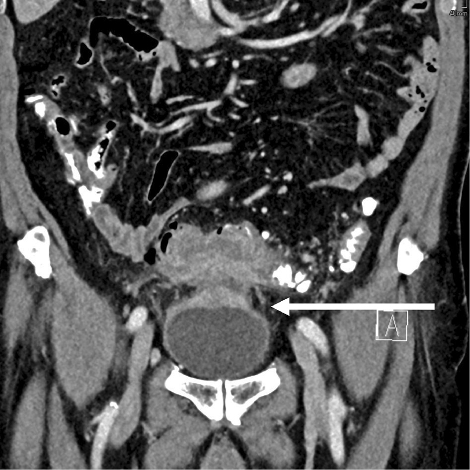 Imaging of colorectal cancer – the clue to individualized...