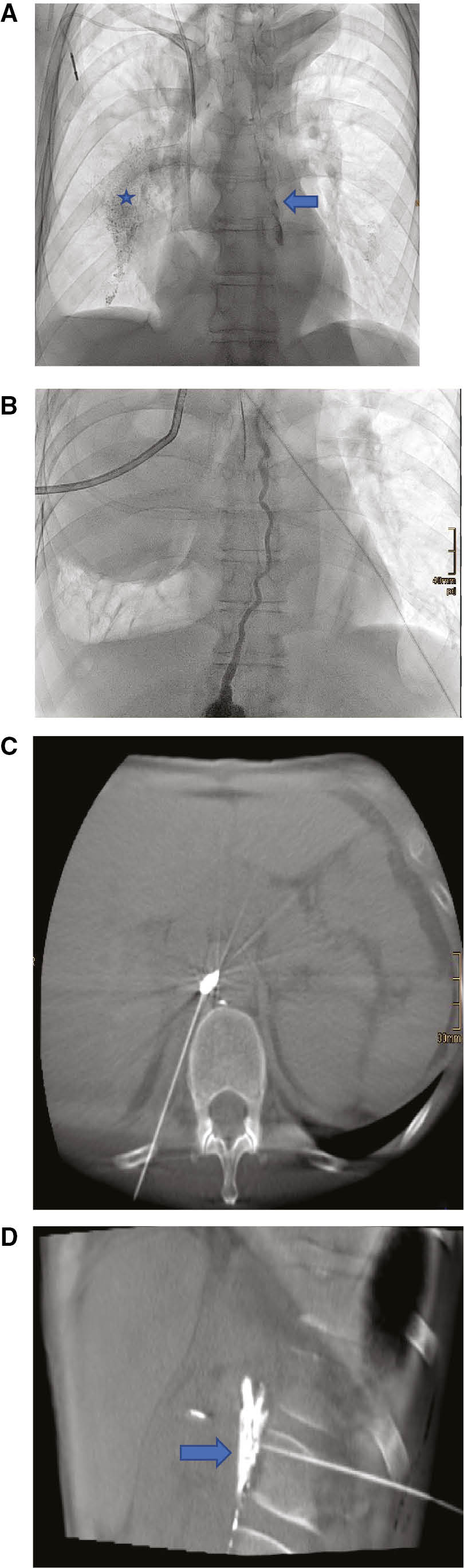 Ultrasound-guided lymphangiography and interventional embolization of ...