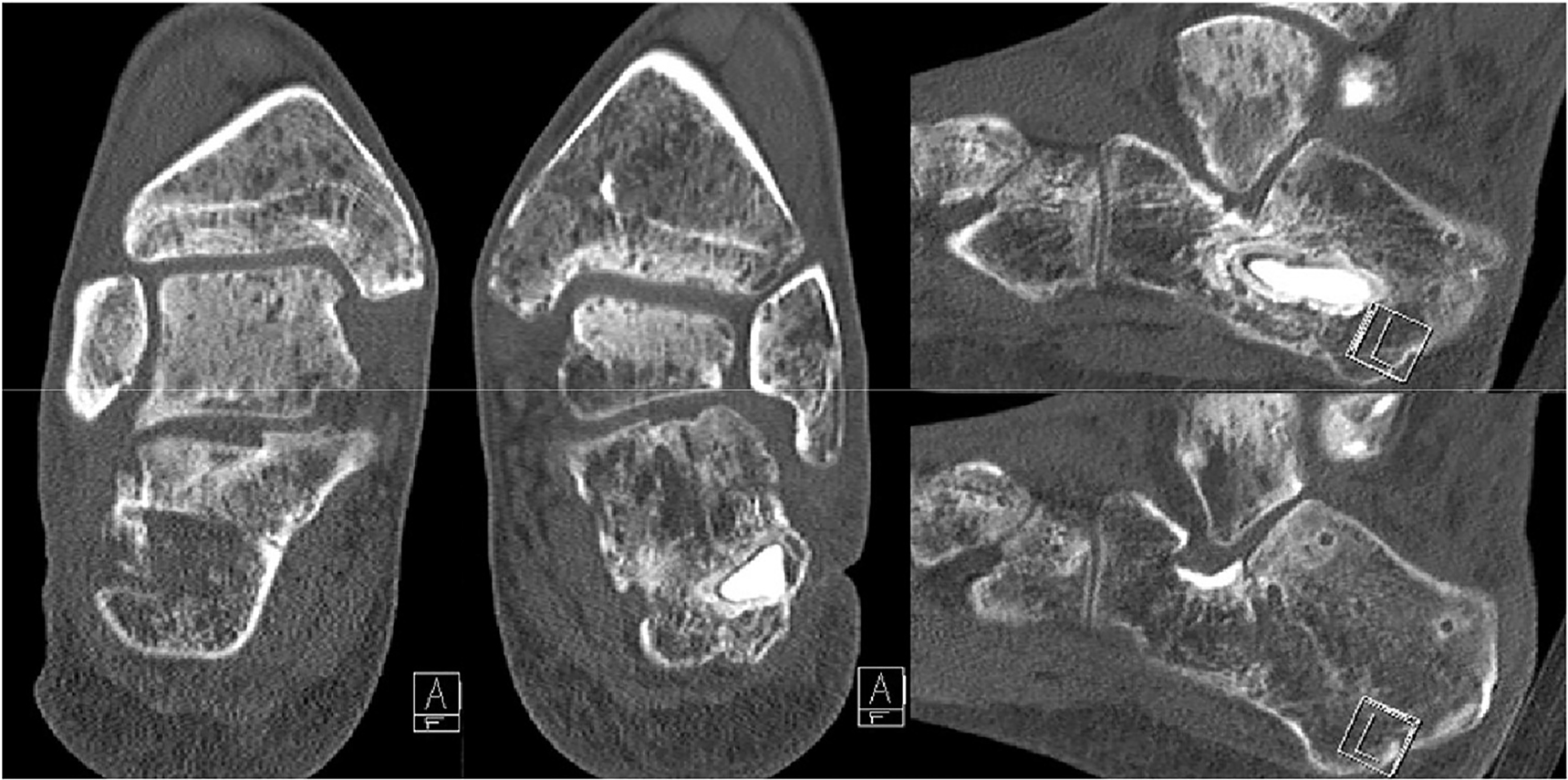 Personalized approach for complex bilateral calcaneal osteomyelitis and ...