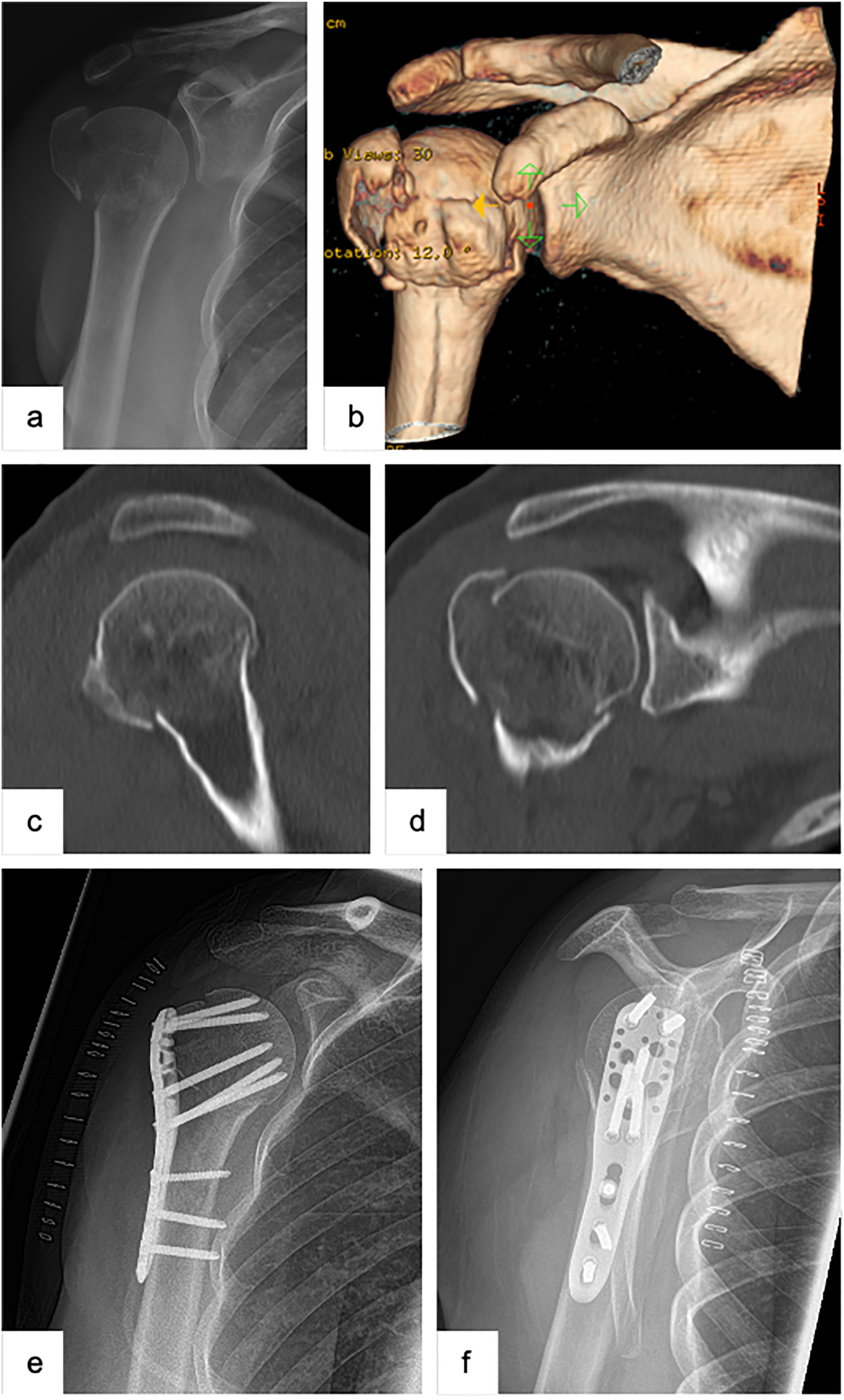 Proximal humerus fracture and acromioclavicular joint dislocation