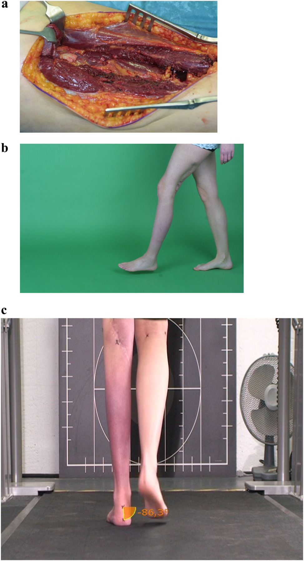 Biological conduits based on spider silk for reconstructi...