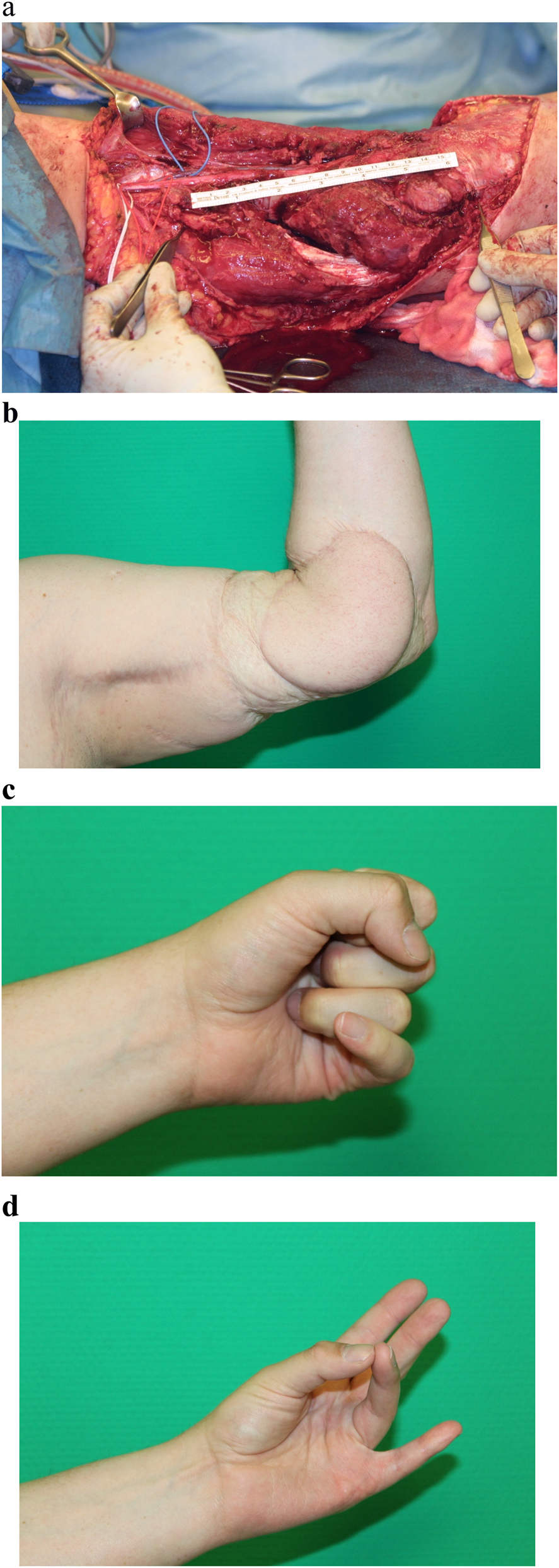 Biological conduits based on spider silk for reconstructi...